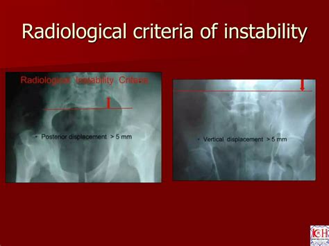 Pelvis Acetabulum Anatomy Imaging Classification Pptx
