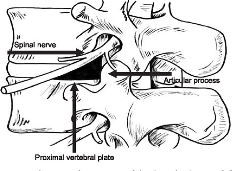 Figure 1 From Kambins Triangle Approach Of Lumbar Transforaminal
