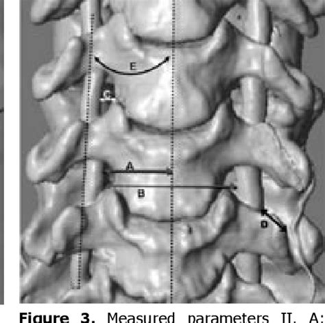 PDF Evaluating The V Segment Of The Vertebral Artery With Computed Tomography To Assess Risks