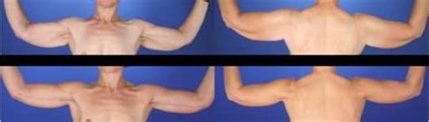 Brachioplasty Bodyaesthetic Plastic Surgery