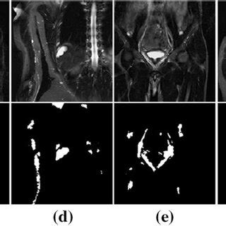 Sample Images To Show The Challenges Of Delineating NF Lesions In MRI Download Scientific