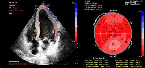 An Example Of Global Longitudinal Strain Speckle Tracking Apical Four
