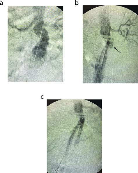 A A Case Of Abdominal Aortic Aneurysm With Angulation Of Infrarenal Download Scientific