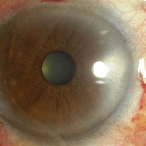 Pterygium Grading System Suggested By Tan Et Al11 Download