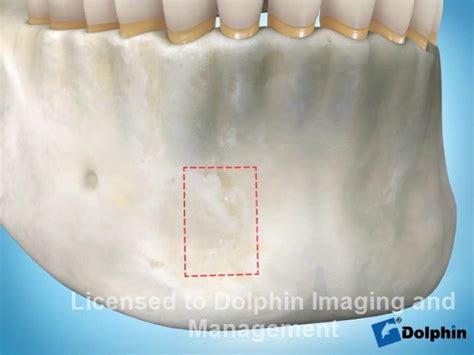 Doctors Videos Backup Dentistry Block Bone Graft For Implant Hq