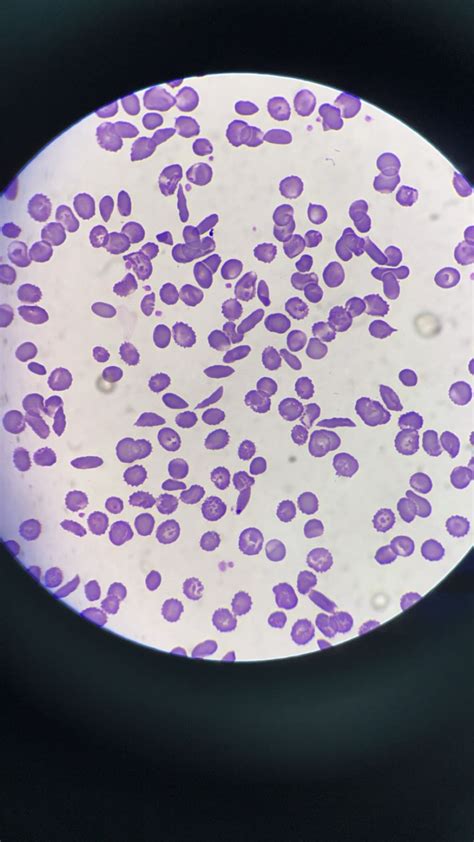 Sickle Cells Anemia Under Microscope Achraf Bladi