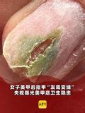女子美甲后指甲“发霉变绿” 央视曝光美甲店卫生隐患
