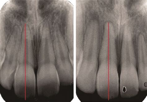 External Apical Root Resorption Is Evaluated By The Measurement Of The Download Scientific