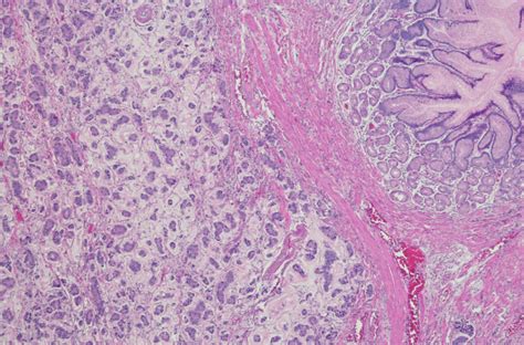 Gastric Cancer Treatment And Pharmacologic Management