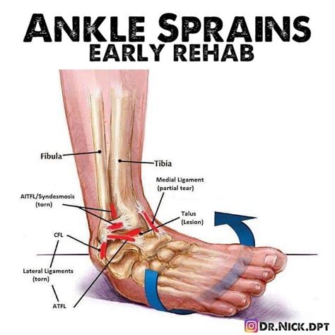 Ankle Sprain Rehab Tips And Exercises