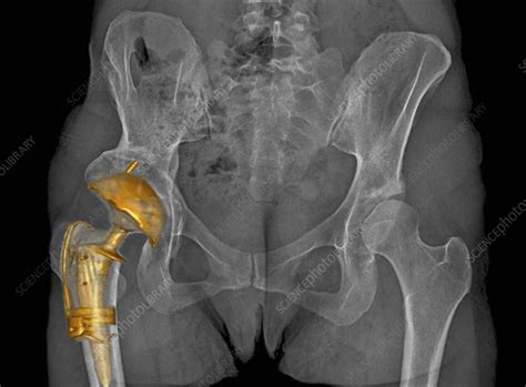 Hip Replacement 3d Ct Scan Stock Image C021 2000 Science Photo Library