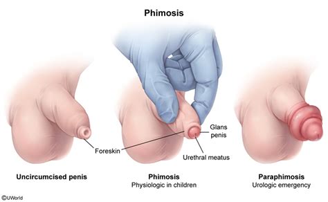 Phimosis Male Reproductive System Uworld Medical Library