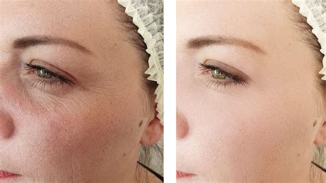 Thread Lift Vs Botox Navigating The World Of Anti Aging Procedures