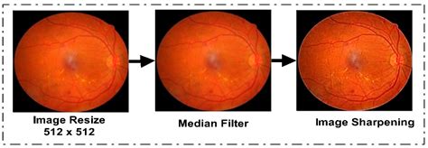 A Hybrid Technique For Diabetic Retinopathy Detection Based On Ensemble