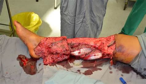 Insane Degloving Trauma Injury Of The Lower Leg