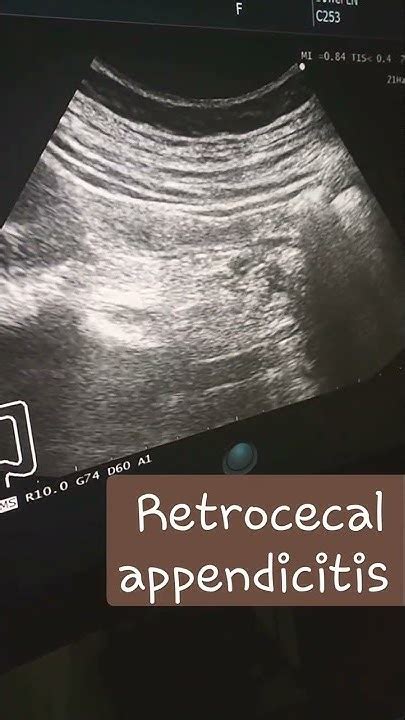 Retrocecal Appendicitis Ultrasound Ultrasound Cases Youtube