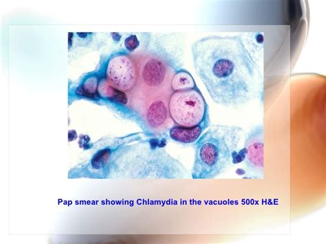 Chlamydia