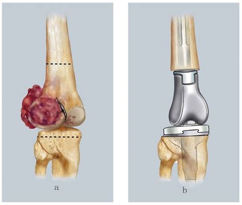 Knee Archives Joint Clinic Paarl
