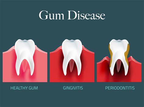 Cloves Periodontal Disease At Timothy Mitchell Blog