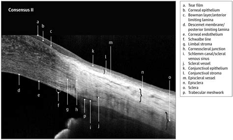 Panel Proposes Standardized Nomenclature For As Oct Findings