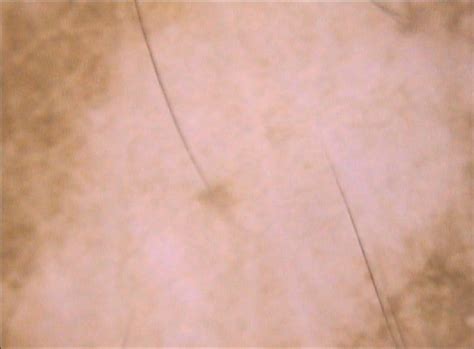 The Utility Of Dermoscopy In The Diagnosis Of Evolving Lesions Of