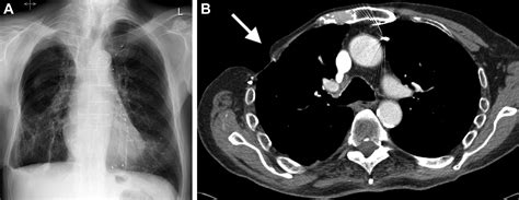Lung Hyperlucency Chest Lung Hyperlucency Chest