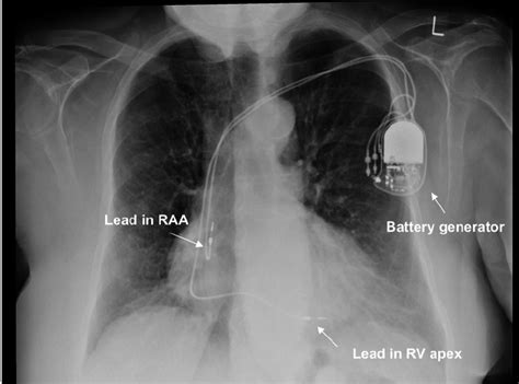 Icd Vs Pacemaker Cxr Chest X Ray Pa Male Patient Vvir Pacemaker On My