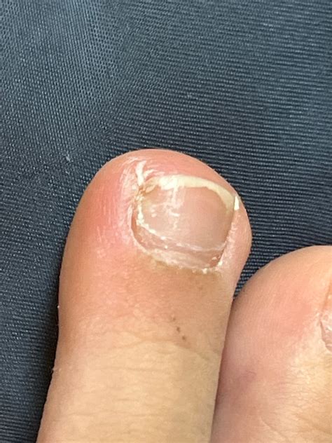 두번째 발가락이 아파요ㅠㅠㅠ 지식in