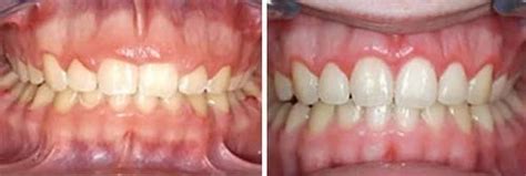 Gingivectomy And Gingivoplasty In Indore Id 7531736291