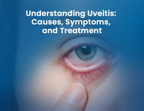 Understanding Uveitis Causes Symptoms And Treatment Al Salama Eye
