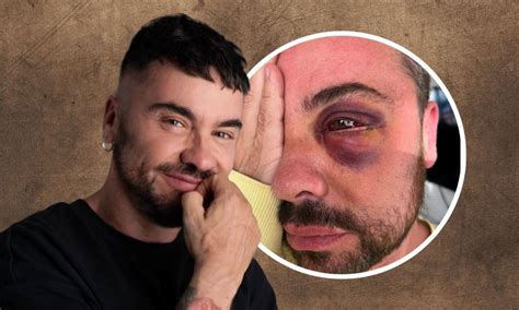 Shiky Clement Revive El Momento En El Que Se Quedó Ciego De Un Ojo Y