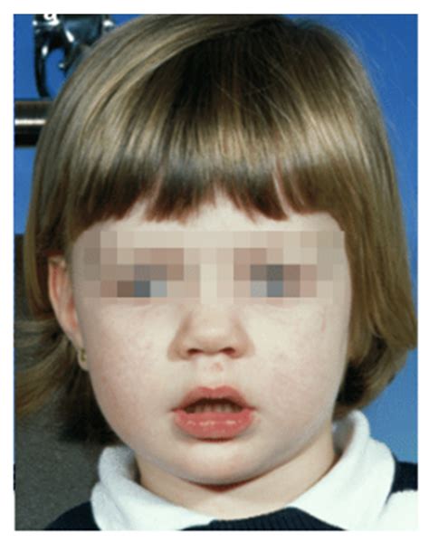 Obstructive Sleep Apnea Role Of A Dentist