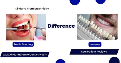 Difference Between Teeth Bonding Vs Veneers Based On Reviews