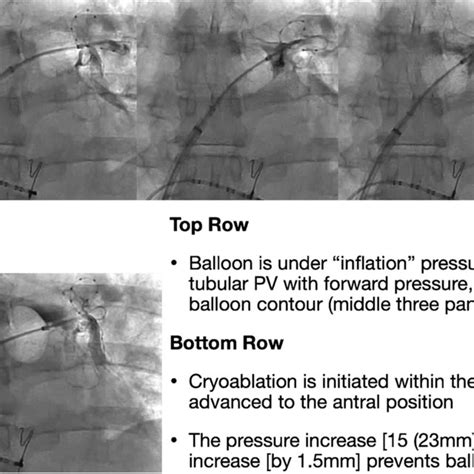 Five Steps To Ensure A Safe And Effective Cryoballoon Procedure Download Scientific Diagram