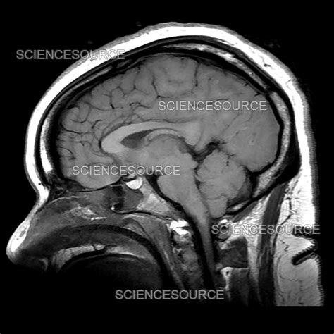 Photograph Diffuse Anoxic Injury After Cardiac Ar Science Source Images