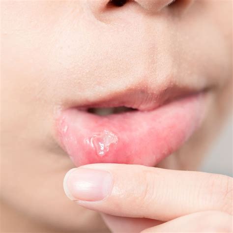 Afta Nem Fertőz De Kialakulása Más Betegségekre Is Utalhat Greendex