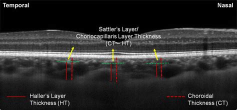 Illustration Of The Method Used To Analyze The Choroidal Vasculature On Download Scientific