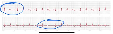 Ive Been Having This Flutter Feeling Like My Hearts Skipping A Beat