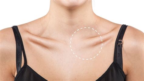 Best Exercises For Sternoclavicular Joint Dislocation With Pictures