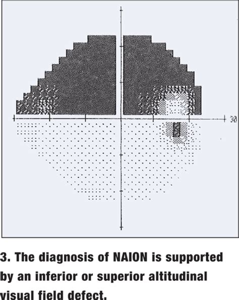 Neurological Visual Field Defect