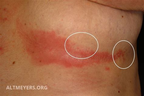 Candidiasis Skin Folds