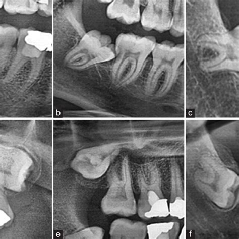 Winters Categorization Depends On The Relation Of The Impacted Third