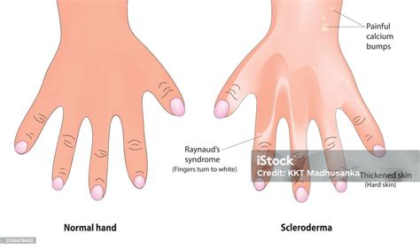 Scleroderma On The Hand Stock Illustration Download Image Now Adult Allergy Allergy