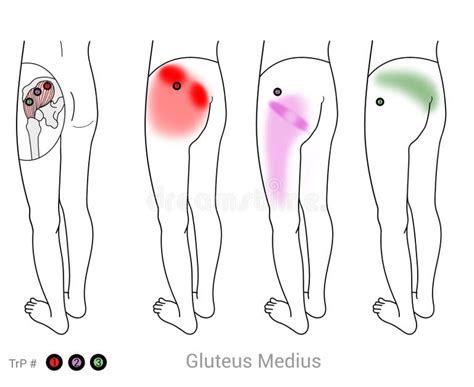 Gluteus Medius Myofascial Trigger Point And Hip Outer Thigh Referred