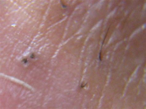 Stages Of Morgellons Disease Morgellons Disease Skin Syndrome Fibers Fiber Search Natural Health