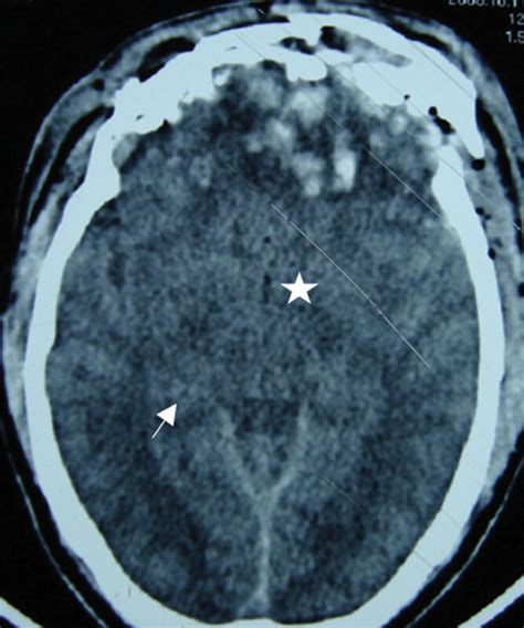 Obliteration Of Quadrigeminal Cistern Arrow And Deformed Third
