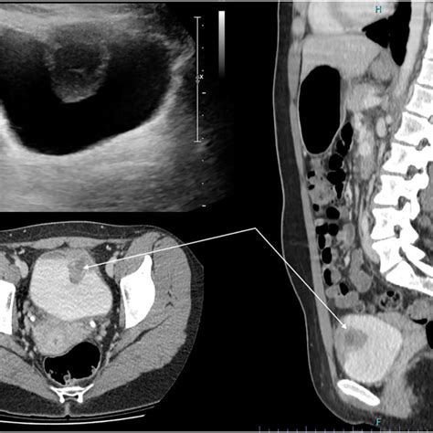Pre Operative Uss And Ct Ivp Demonstrating The Left Anterior Bladder
