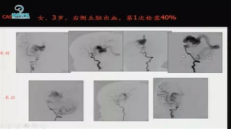 夏鹰教授：脑血管畸形介入治疗的并发症及防治 脑医汇