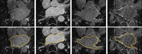Challenges In Segmenting The Left Atrium And Associated Pulmonary