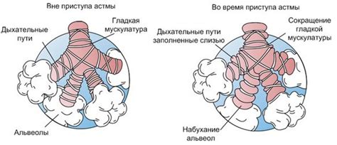Аппарат АСТЕР, купить аппарат АСТЕР для лечения бронхиальной астмы ...